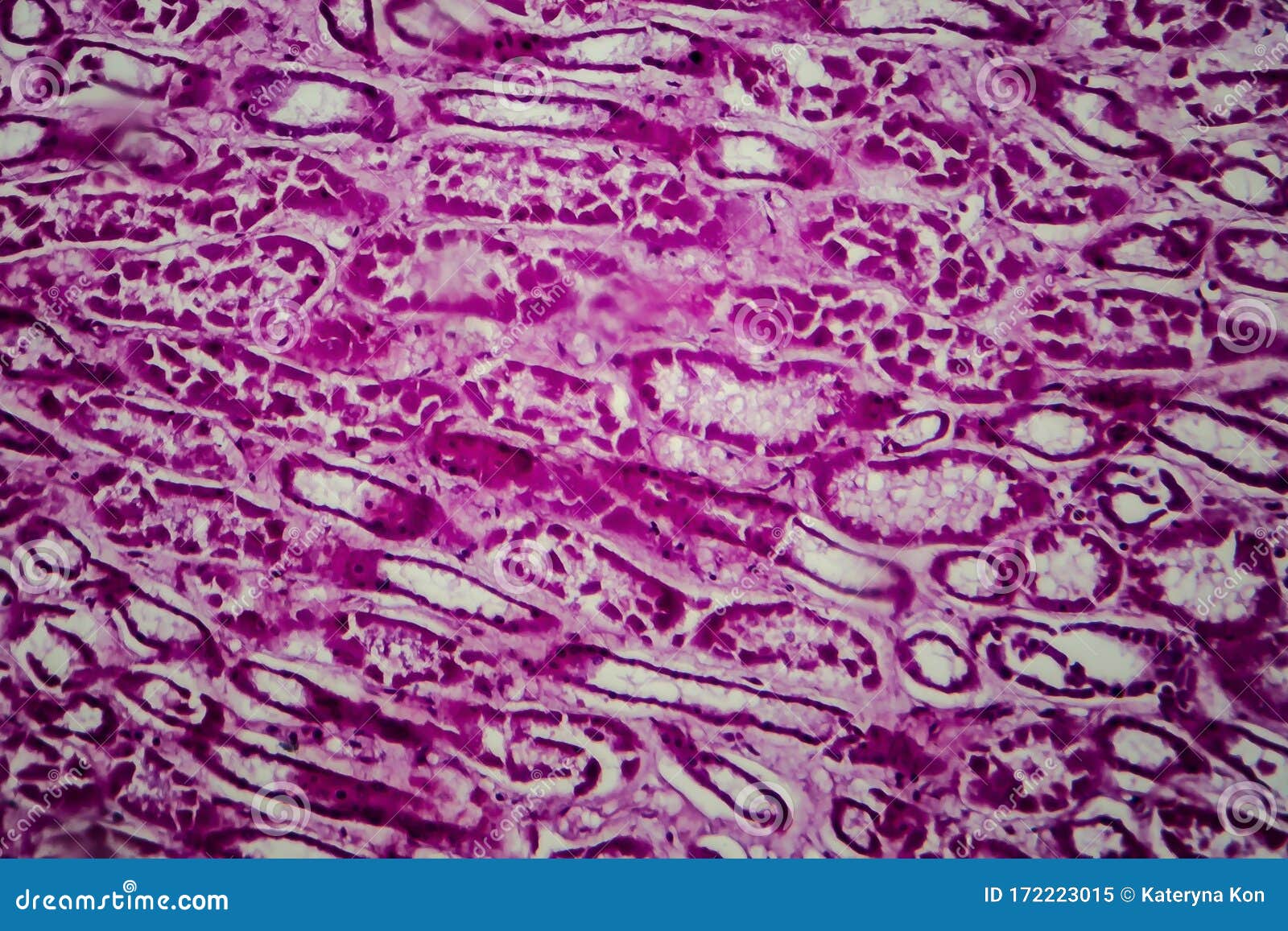 Diffuse Sclerosing Glomerulonephritis Stock Image - Image of microscope ...