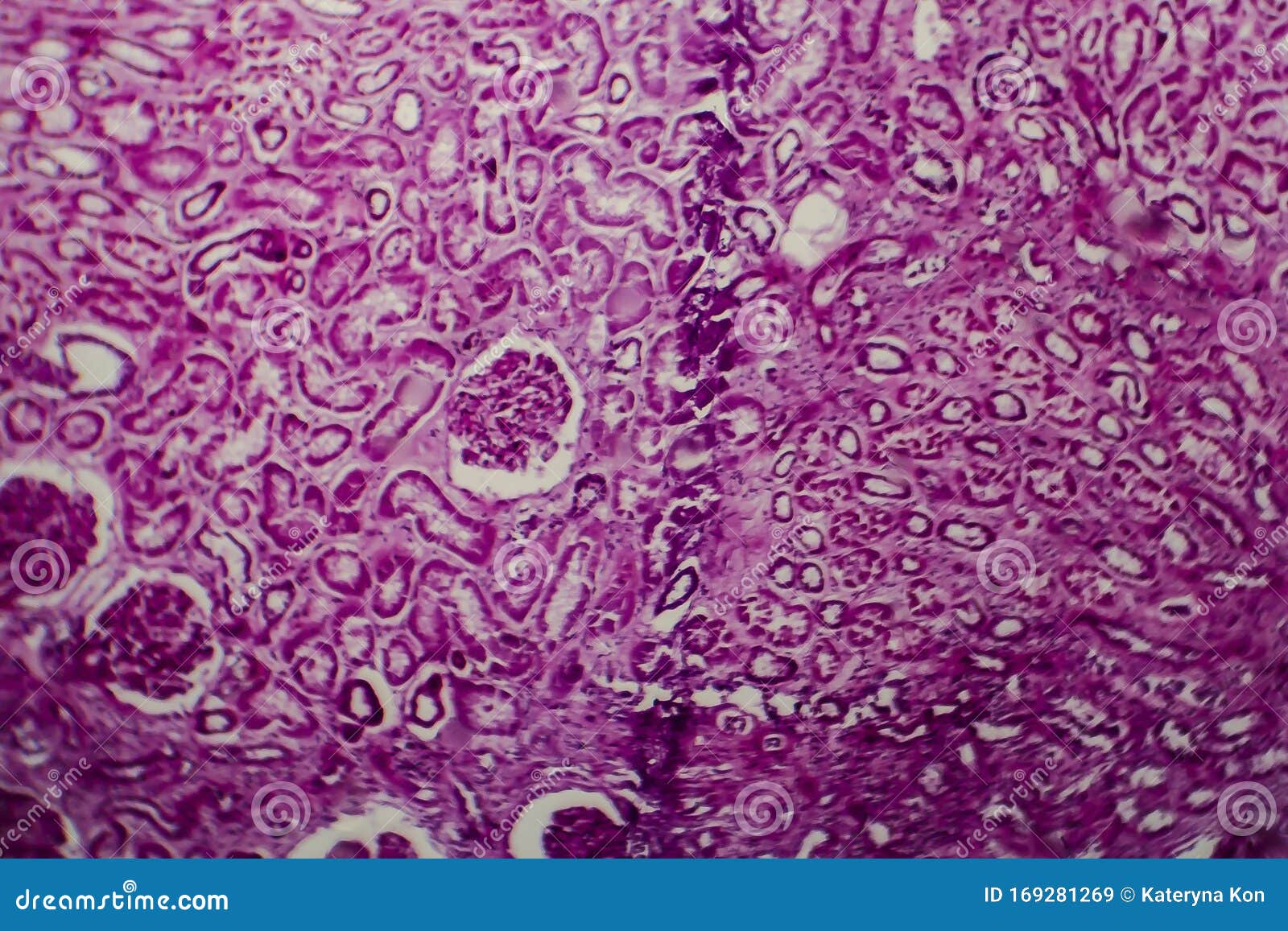 Diffuse Sclerosing Glomerulonephritis Stock Image - Image of sclerosing ...