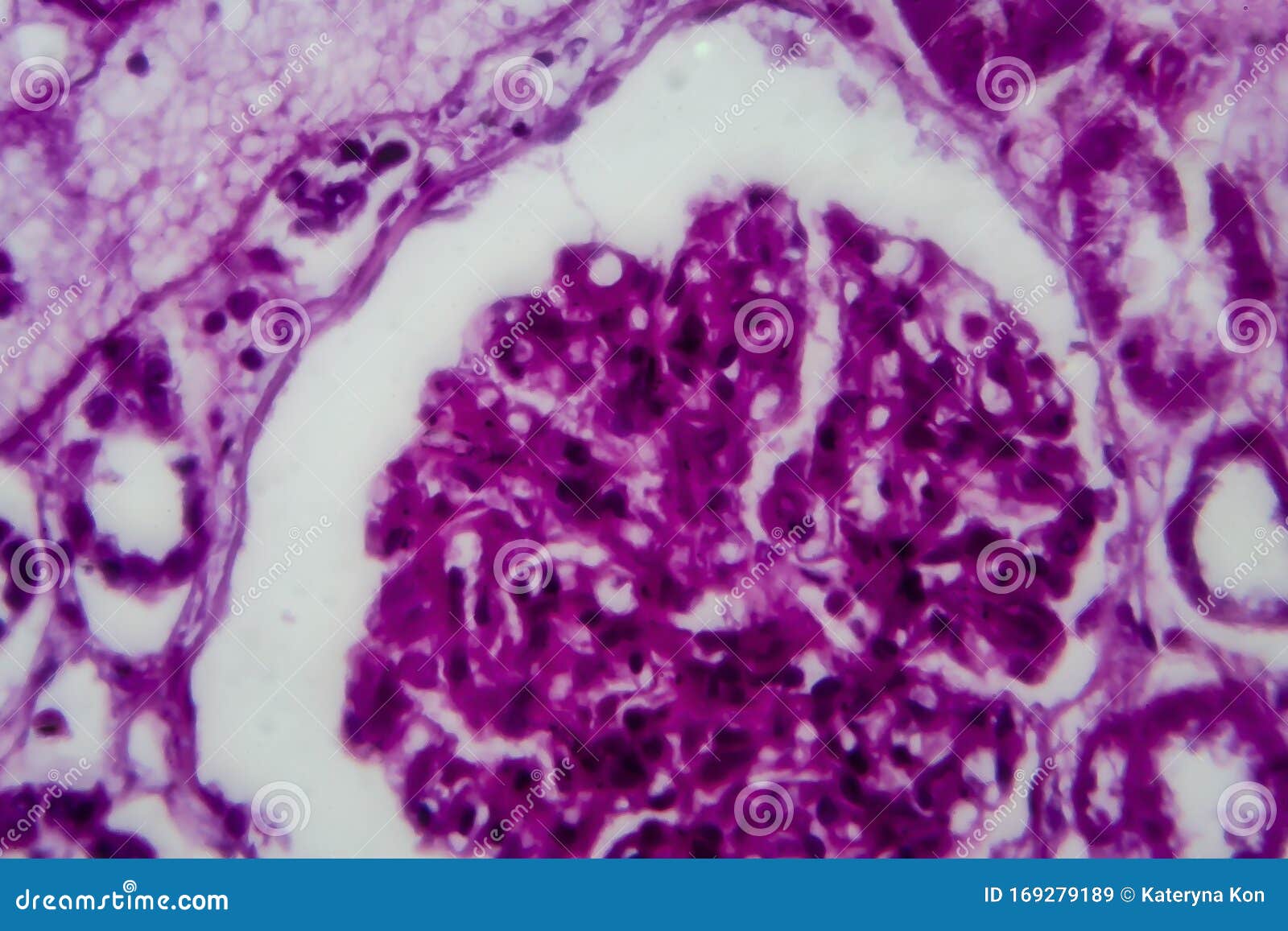 Diffuse Sclerosing Glomerulonephritis Stock Image - Image of morphology ...