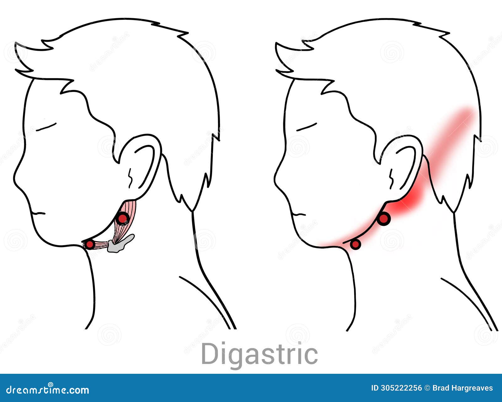 Digastric: Jaw And Head Pain Arriving From Myofascial Trigger Points ...