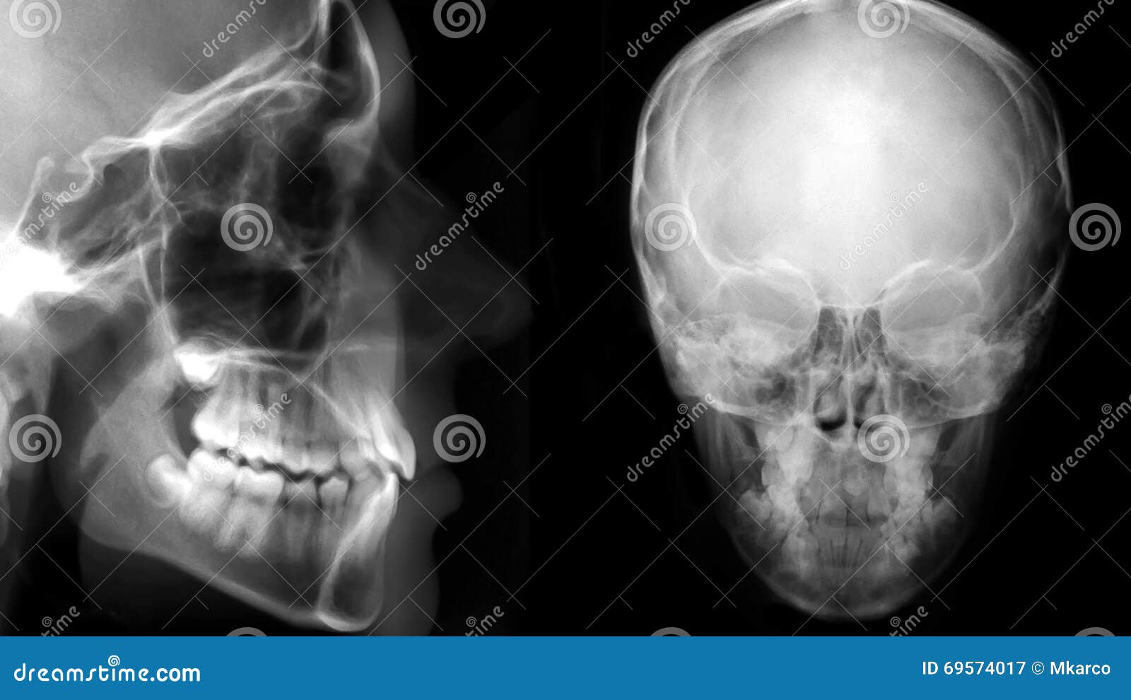 Digital Cephalometric, Frontal and Lateral X-ray Stock Image - Image of ...
