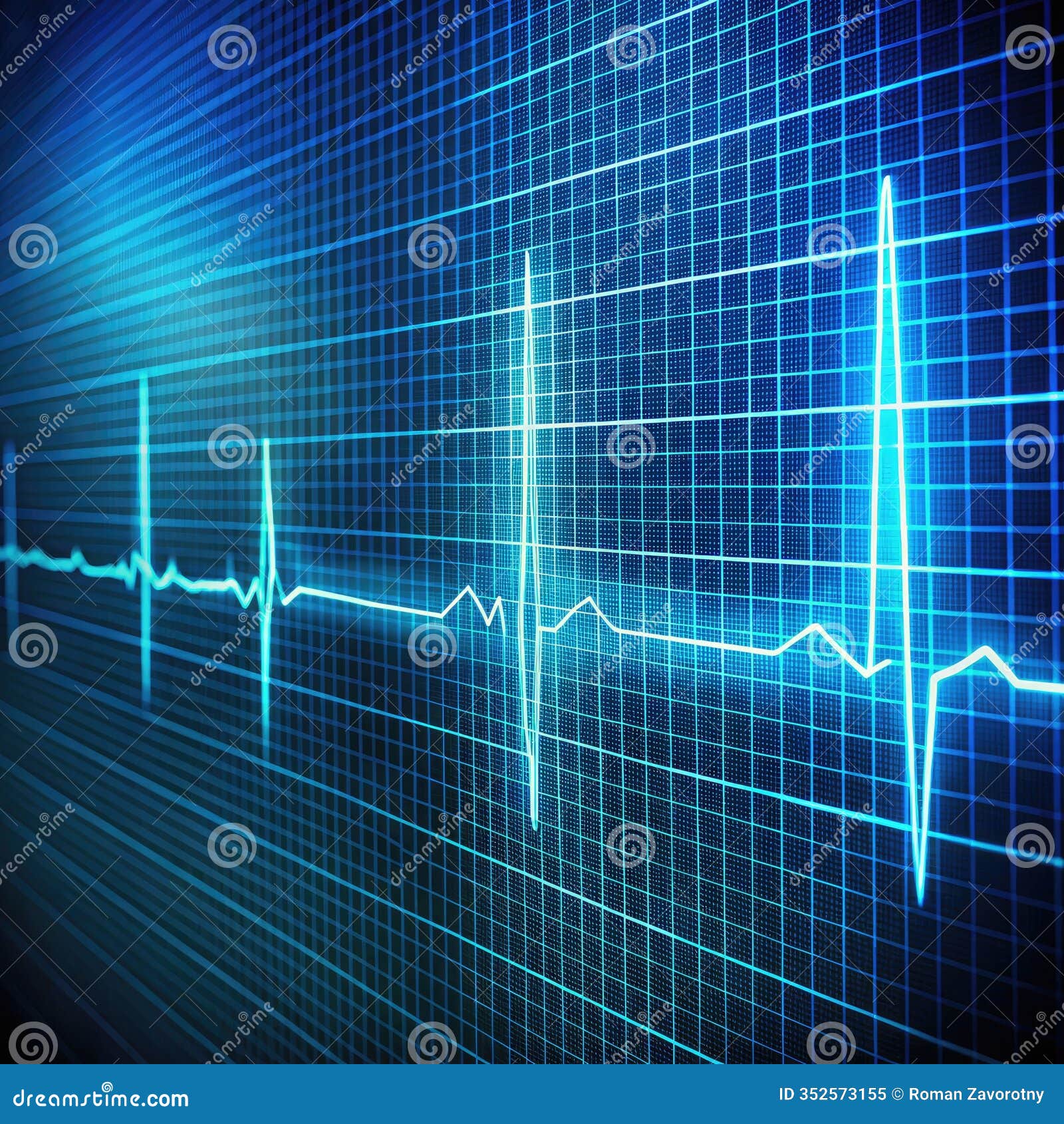 St Elevation Ecg Wave Representation on Standard Scale with Digital ...