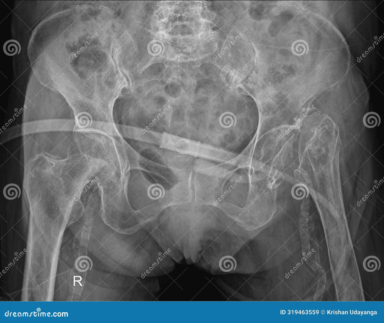 Digital Human Pelvis Radiograph Stock Image - Image of pelvis, human ...