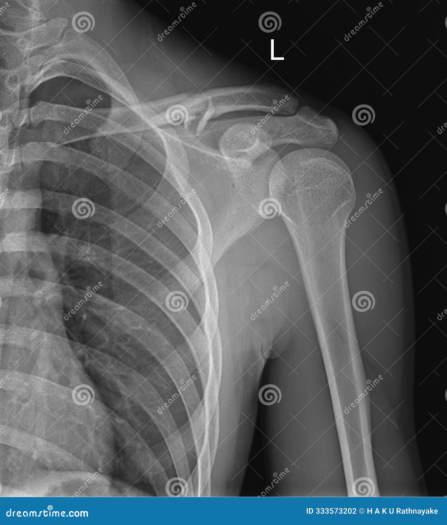 Digital Human Radiograph Showing Shoulder Joint Stock Photo - Image of ...
