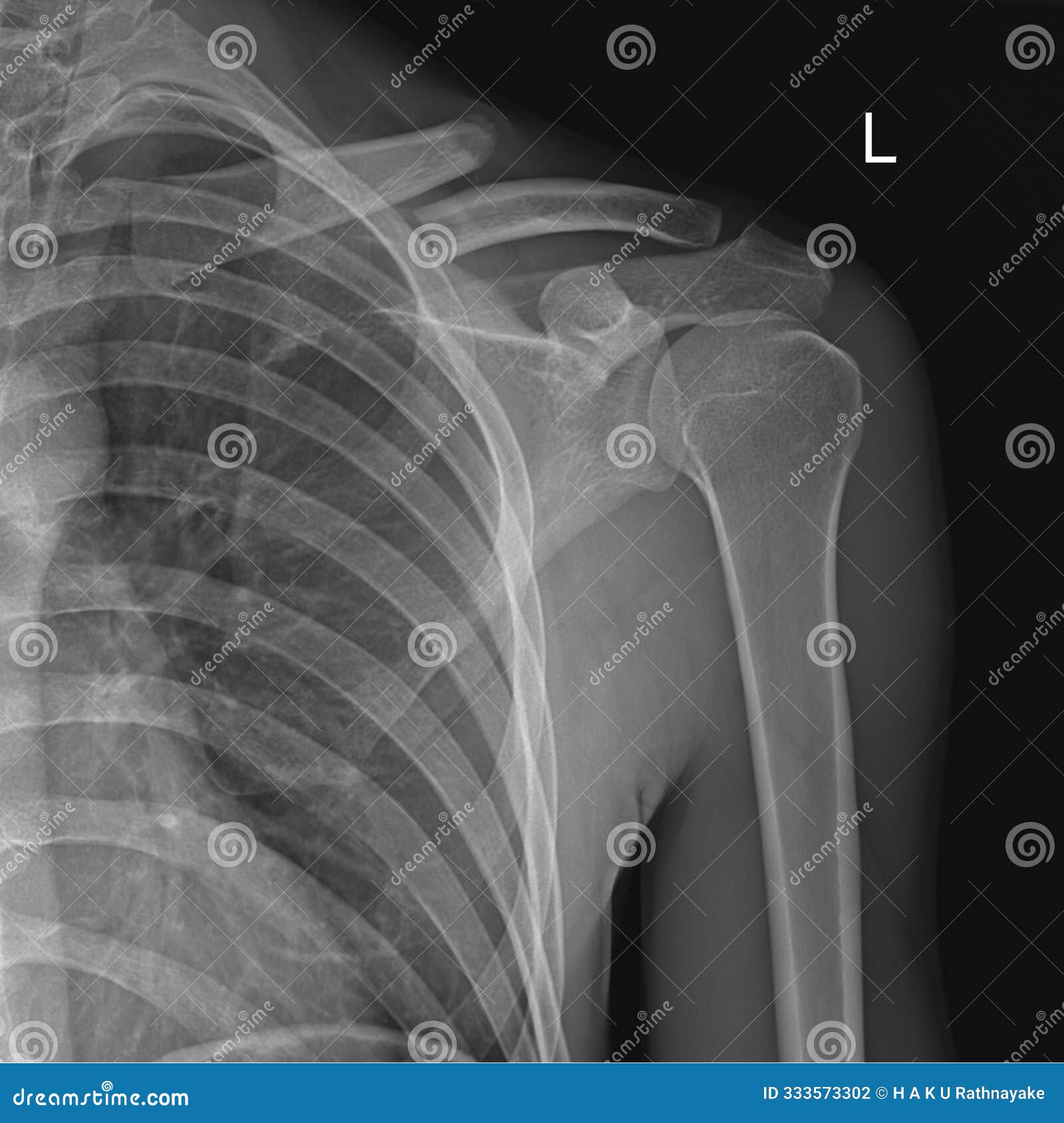 Digital Human Radiograph Showing Shoulder Joint Stock Photo - Image of ...