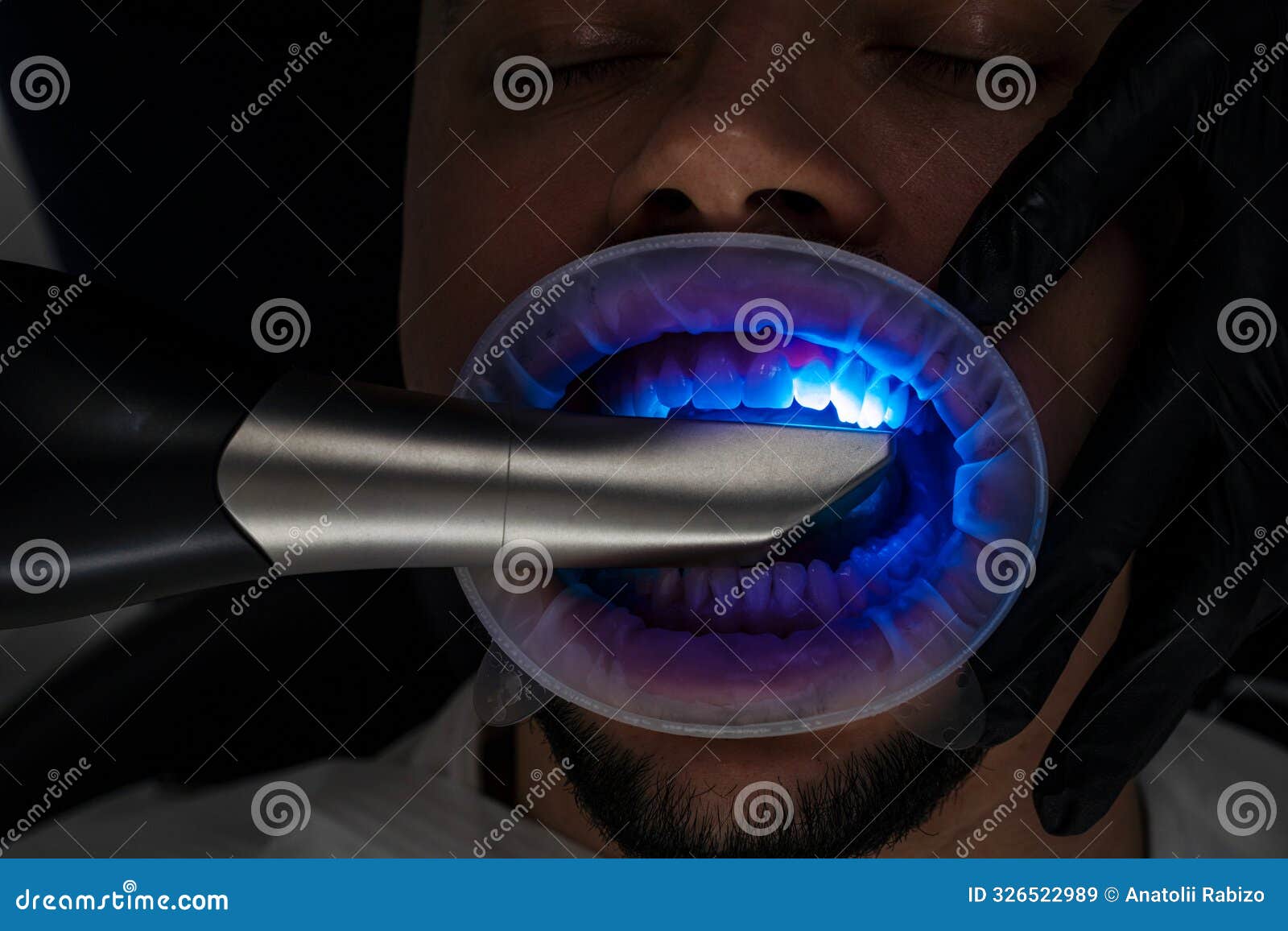 Digital Impressioning Teeth of Patient with 3d Digital Dental Scanner ...