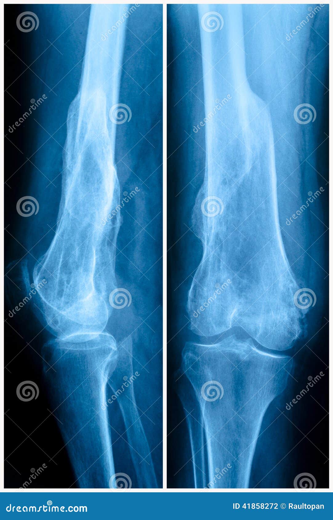 Dijbeenbreuk stock foto. Image of medisch, ziekenhuis - 41858272