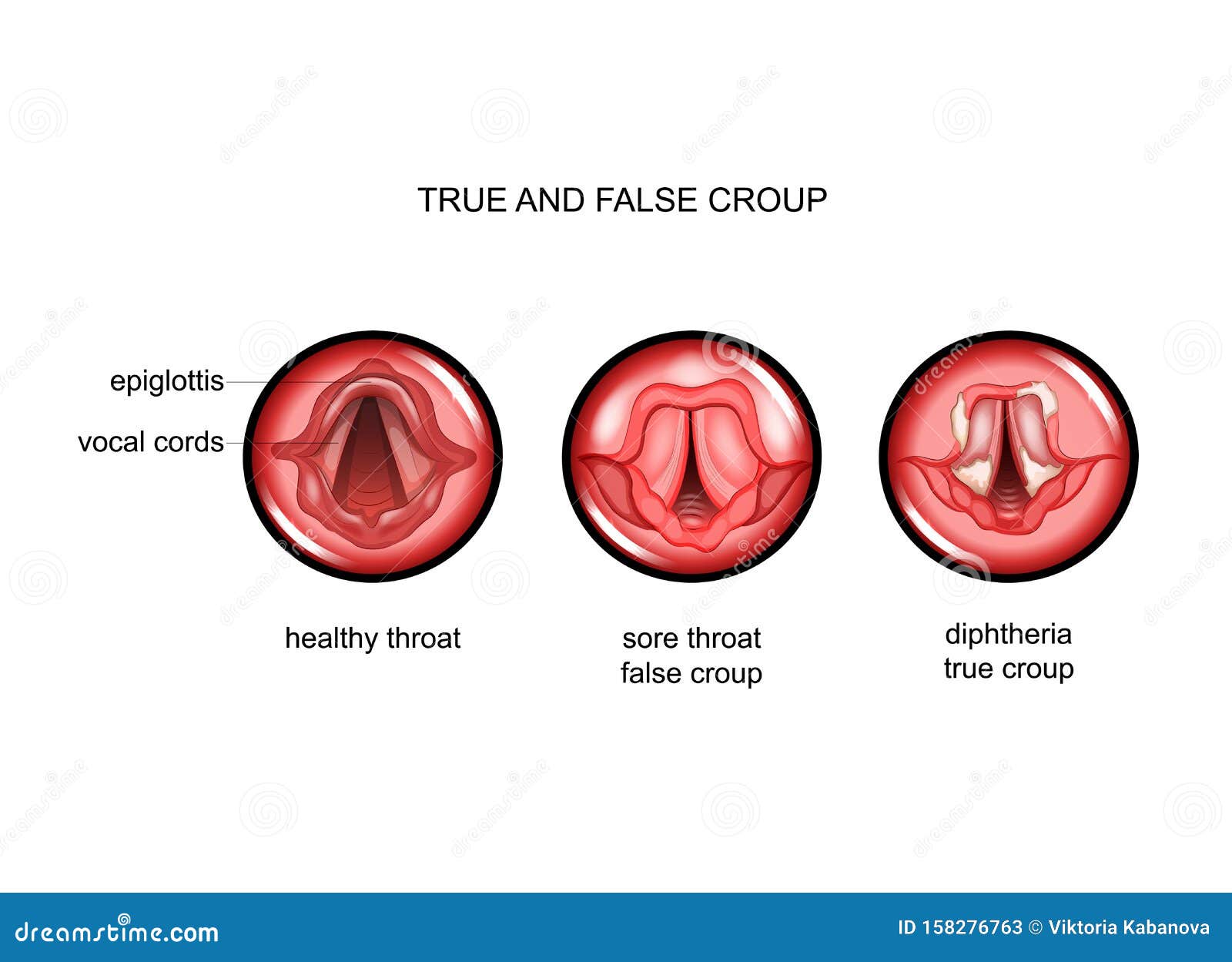 Diphtheria. True and False Croup Stock Vector - Illustration of croup ... Diphtheria. True and False Croup Stock Vector - Illustration of croup ...