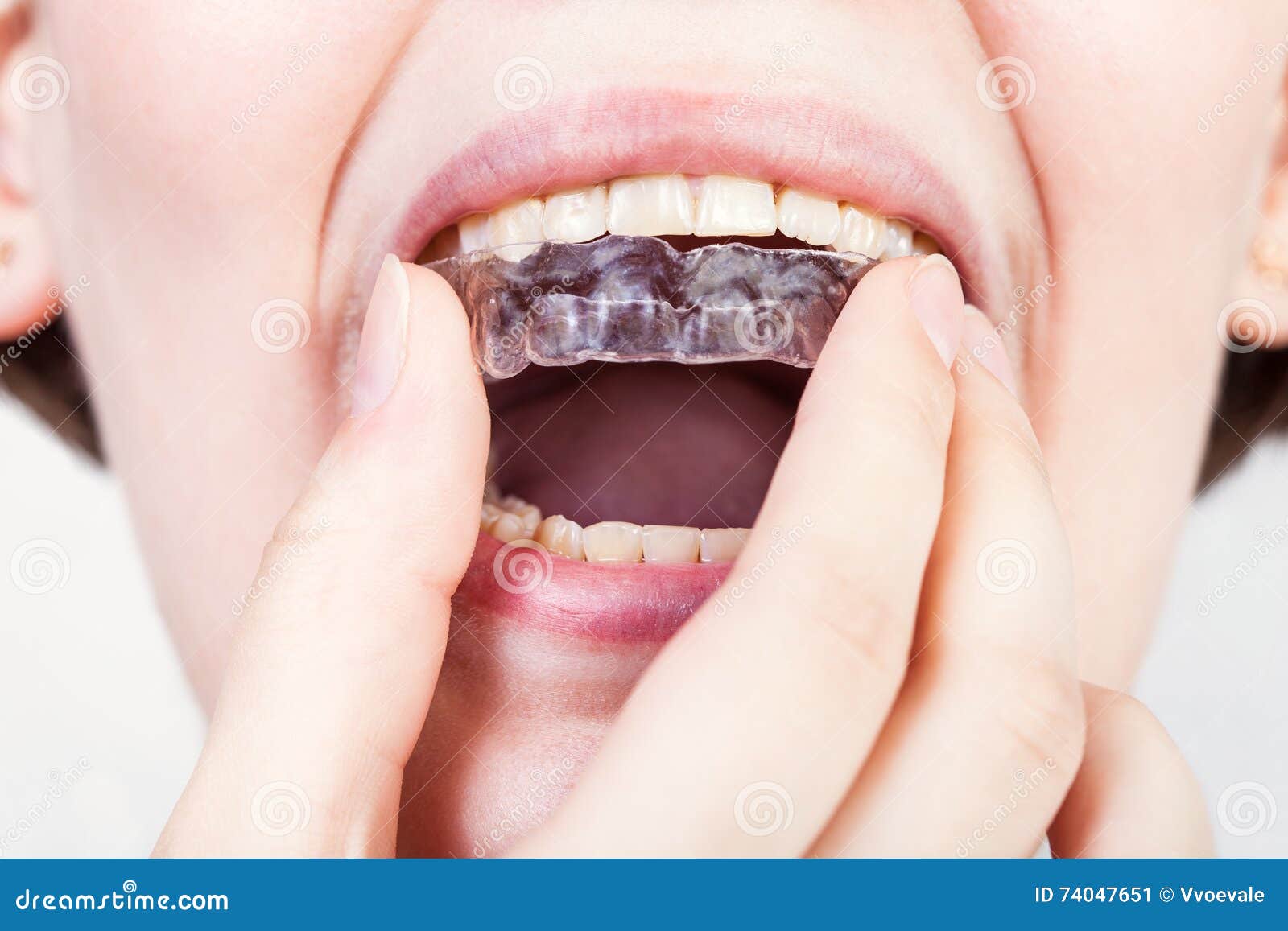 Direct View of Young Woman Fixing Clear Aligner Stock Image - Image of ...