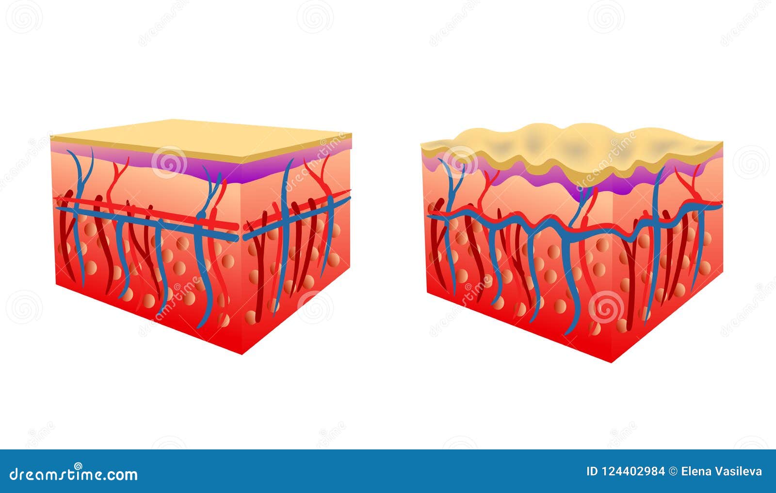 Dirigez L'illustration De Deux Types De Peau Montrant Des Cellulites ...