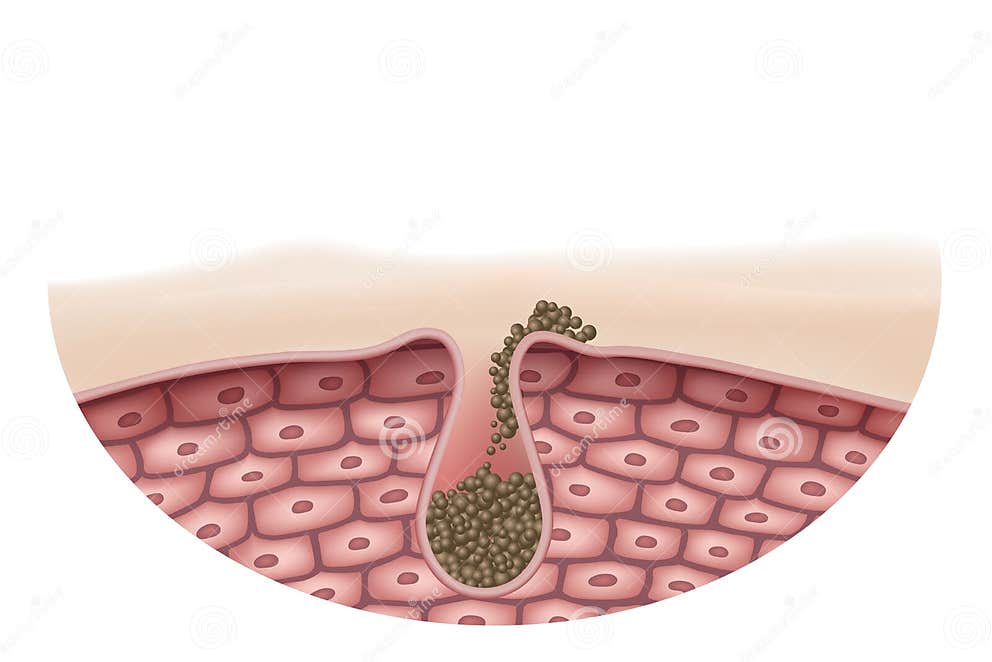 Dirt clogging the skin иллюстрация вектора. иллюстрации насчитывающей ...