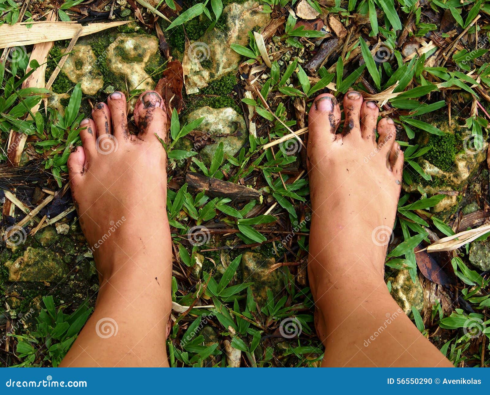 A Bare Leg With A Painful Heel Is Wound In Kind. Women`s Feet Are ...