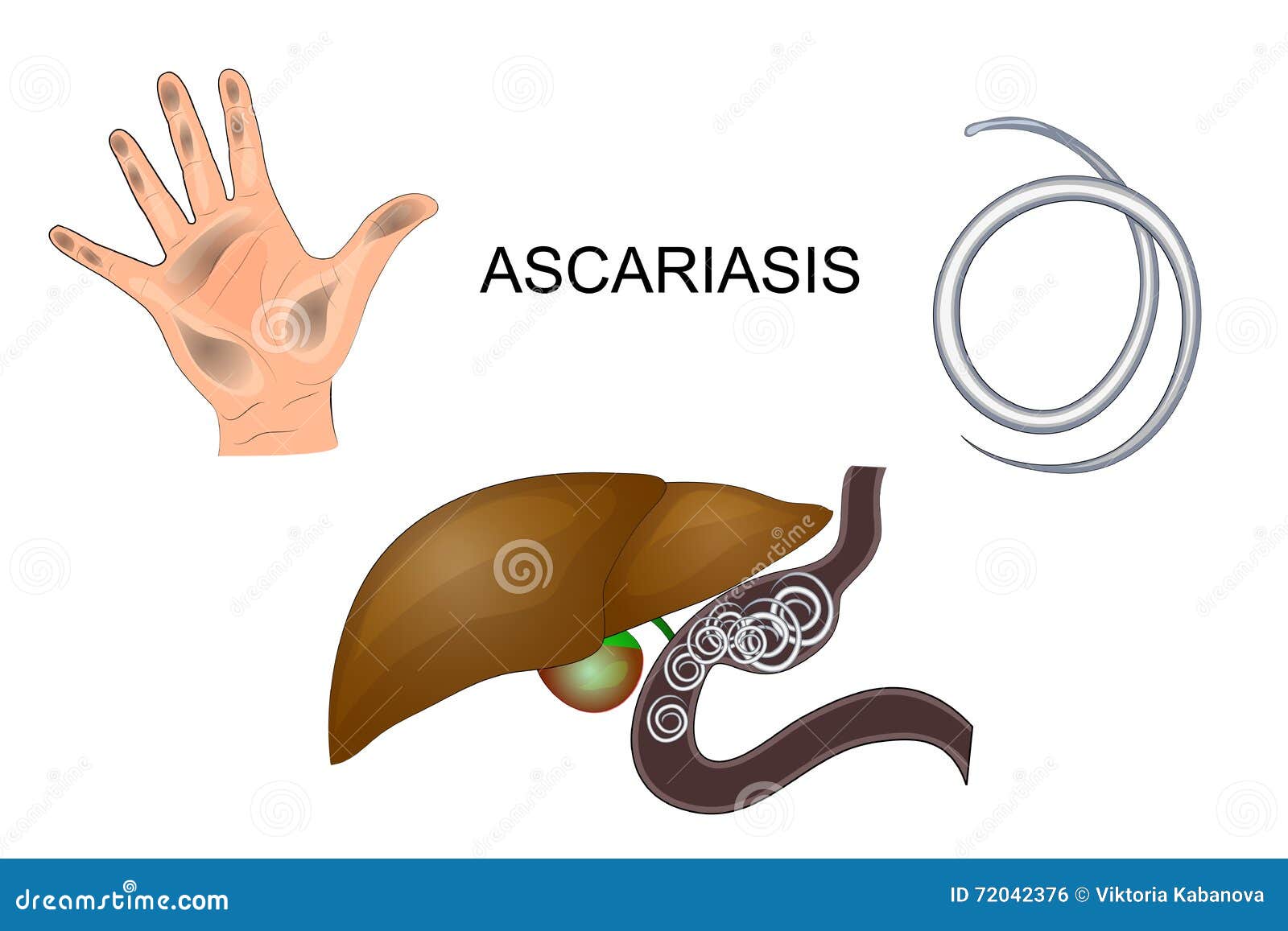 Ascariasis, Roundworm Illustration, Drawing, Engraving, Ink, Line Art ...