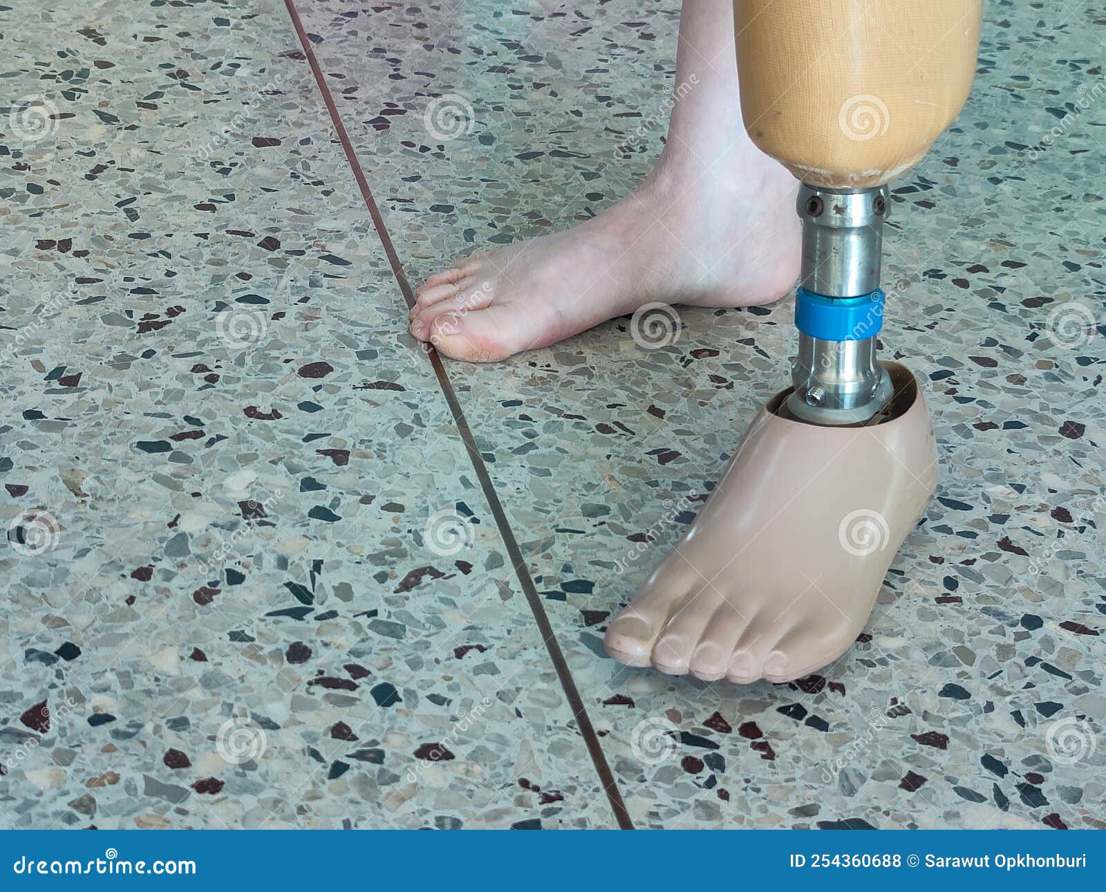 BK Disability Using and Training Leg Prothesis Stock Photo - Image of ...