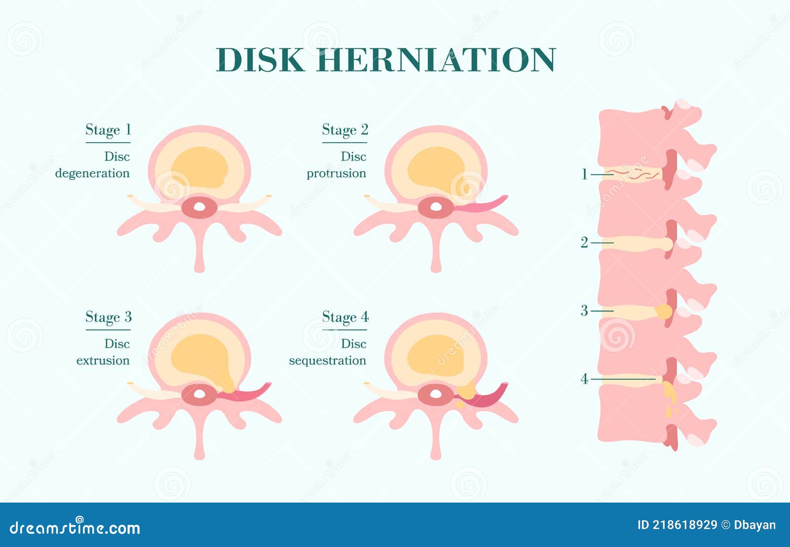 Disc Herhetation, Four Stages and Side View of Spinal Column Stock ...