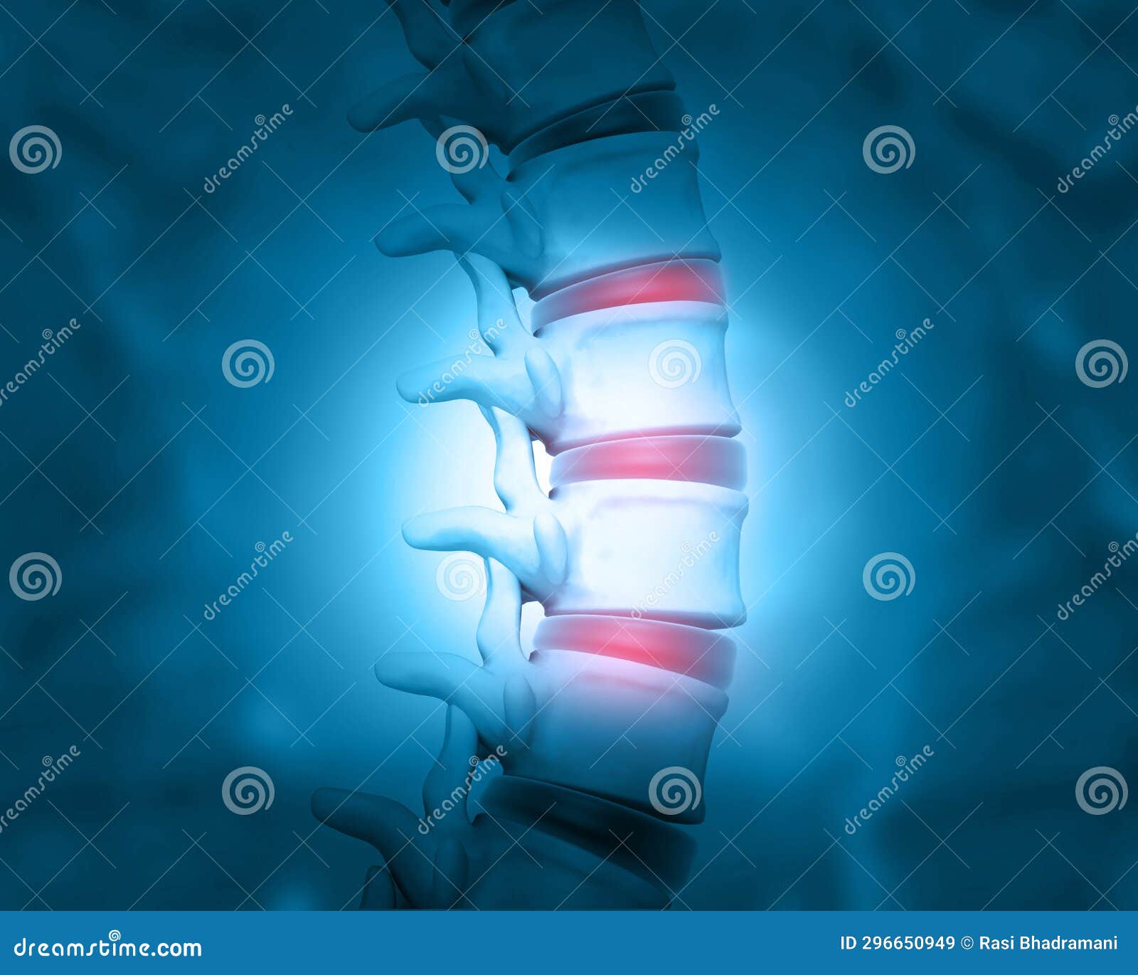 Disc Problem of Human Spine Stock Illustration - Illustration of ...
