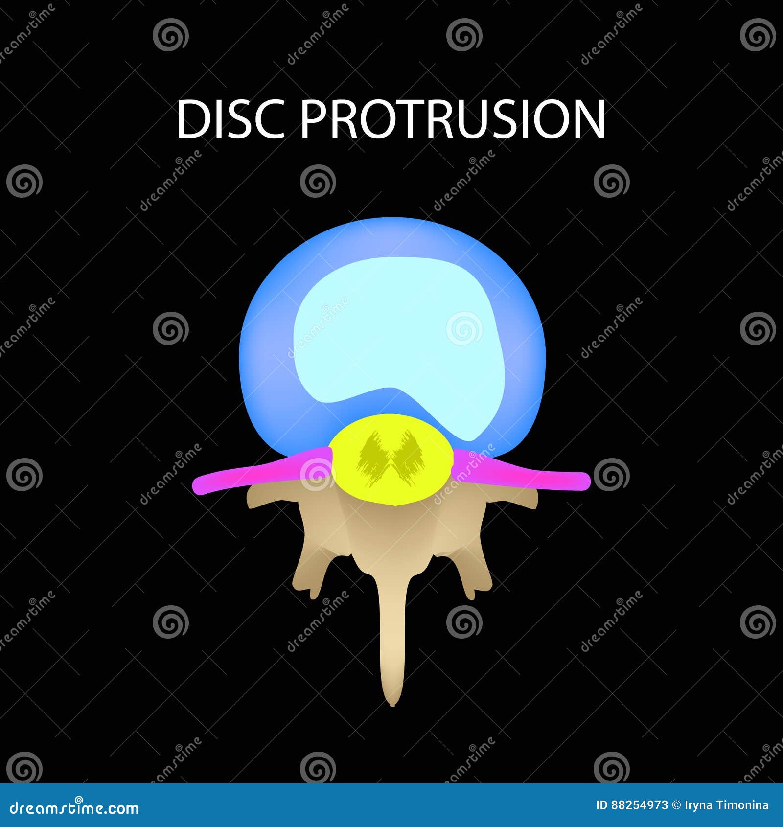 Disc Protrusion. Top View. Spine. Infographics. Vector Illustration On ...