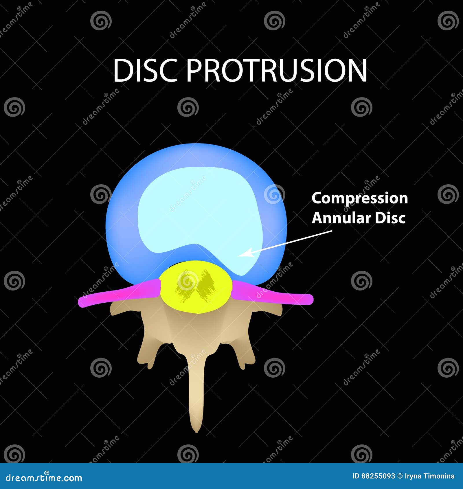 Disc Protrusion. Top View. Spine. Infographics. Vector Illustration On ...