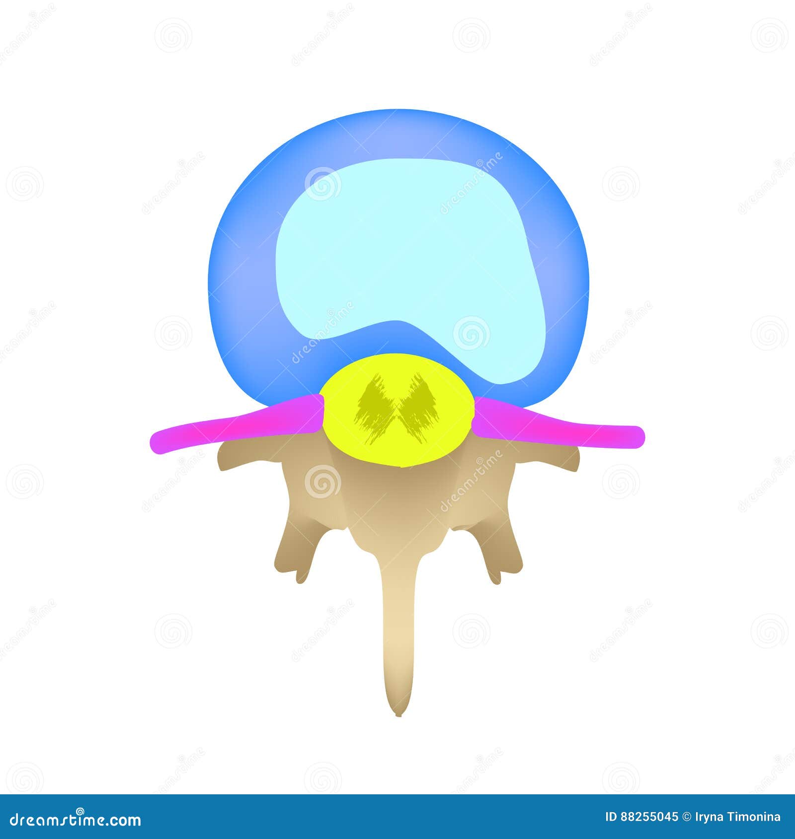 Disc Protrusion. Top View. Spine. Infographics. Vector Illustration On ...