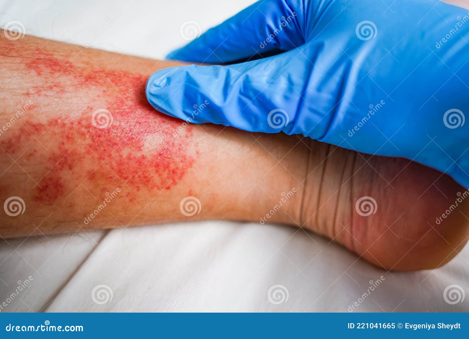 Disease Of The Skin On The Legs Itchy Red Rashes And Spots Stock Image Image Of Adult Eczema