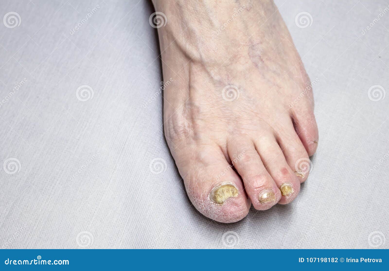 Fungus on toe nails stock photo. Image of issue, dirty - 107198182