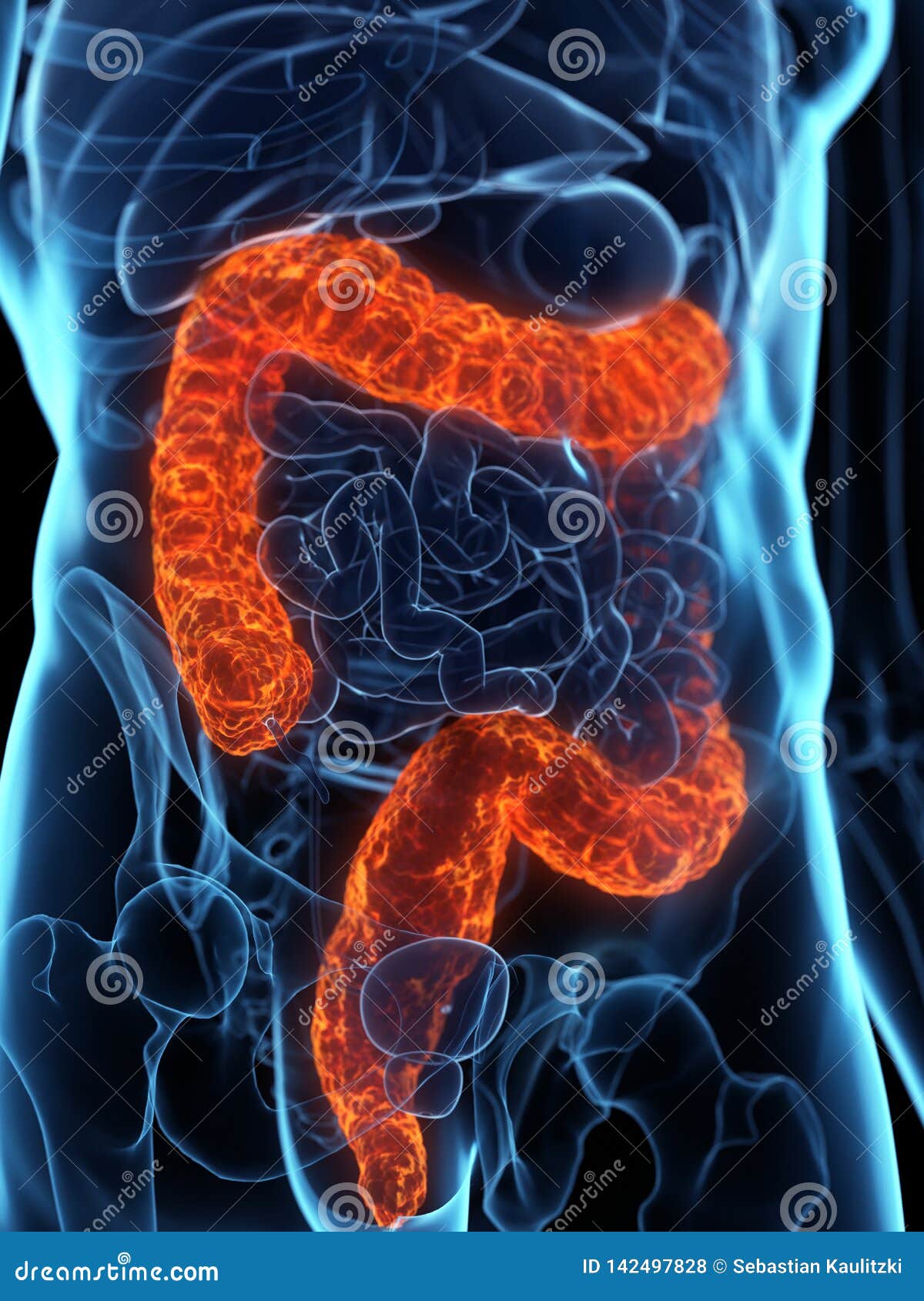 A diseased colon stock illustration. Illustration of diverticulitis ...