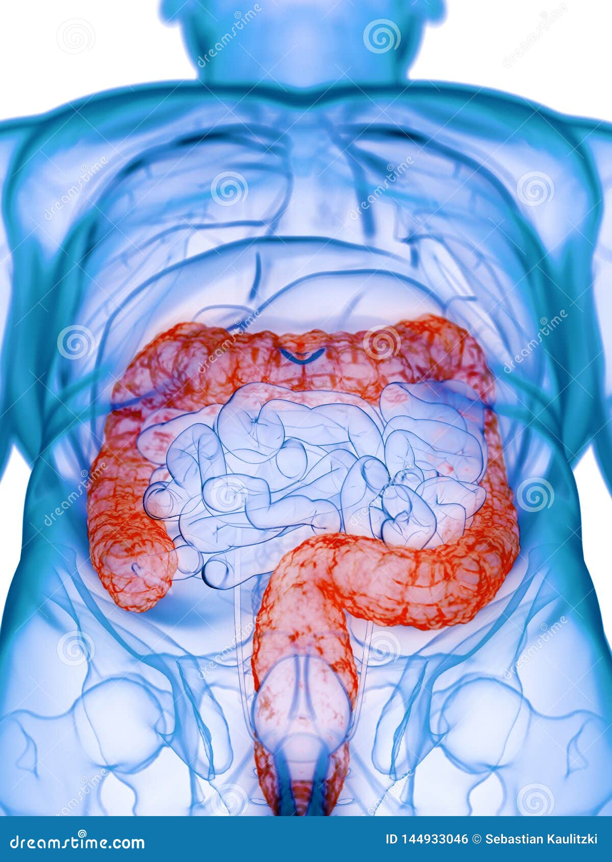 A diseased colon stock illustration. Illustration of descending - 144933046
