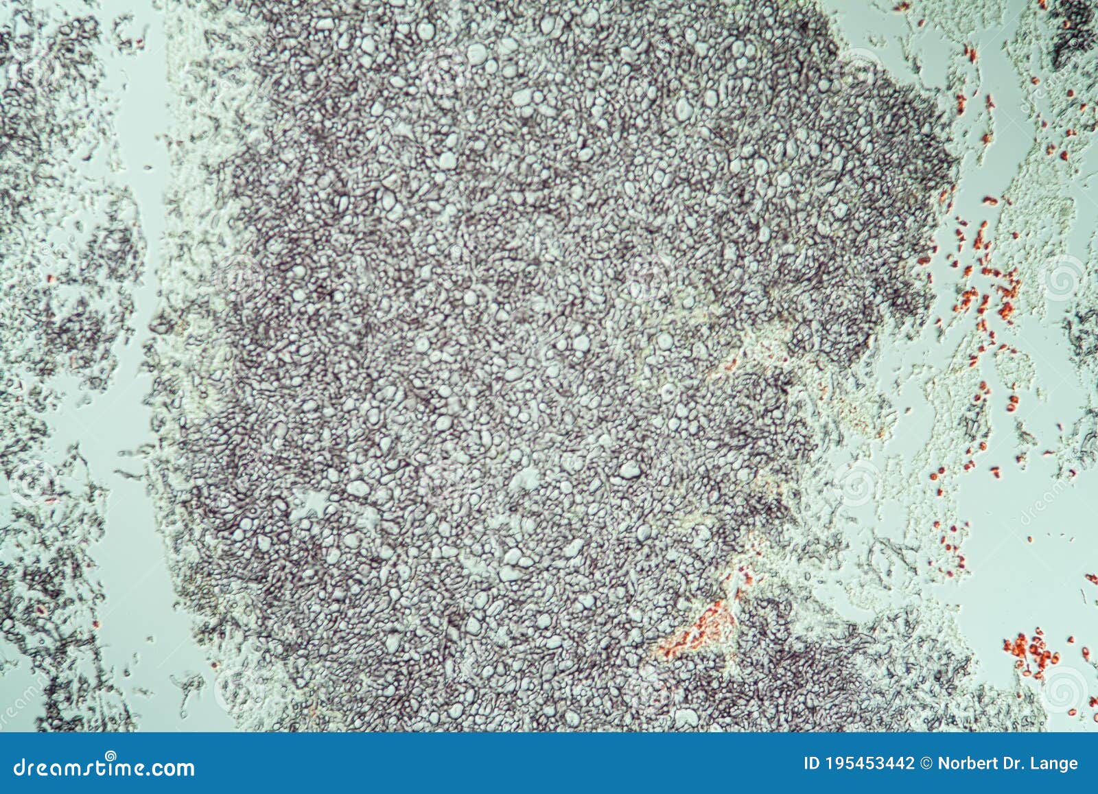 Diseased Ear Tissue Infected with Aspergillus Stock Photo - Image of ...