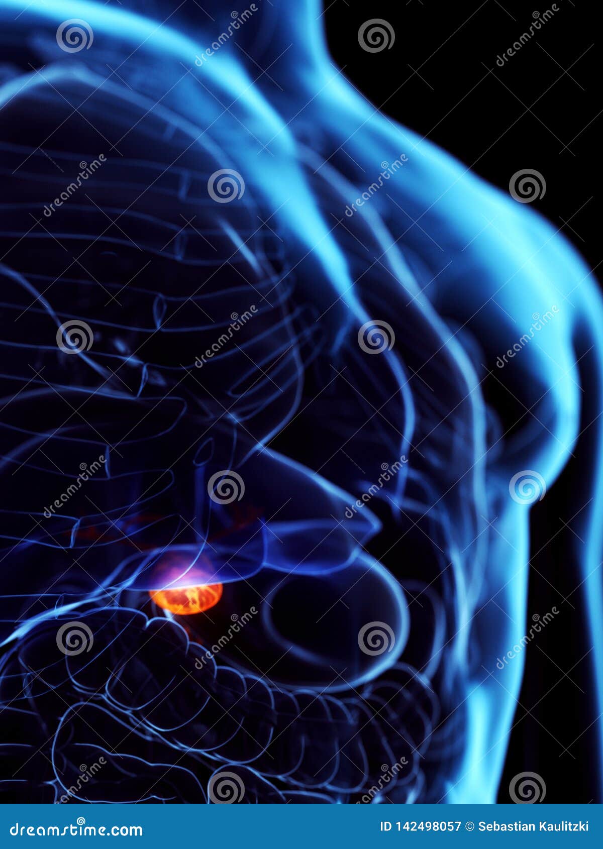 A diseased gallbladder stock illustration. Illustration of disease ...
