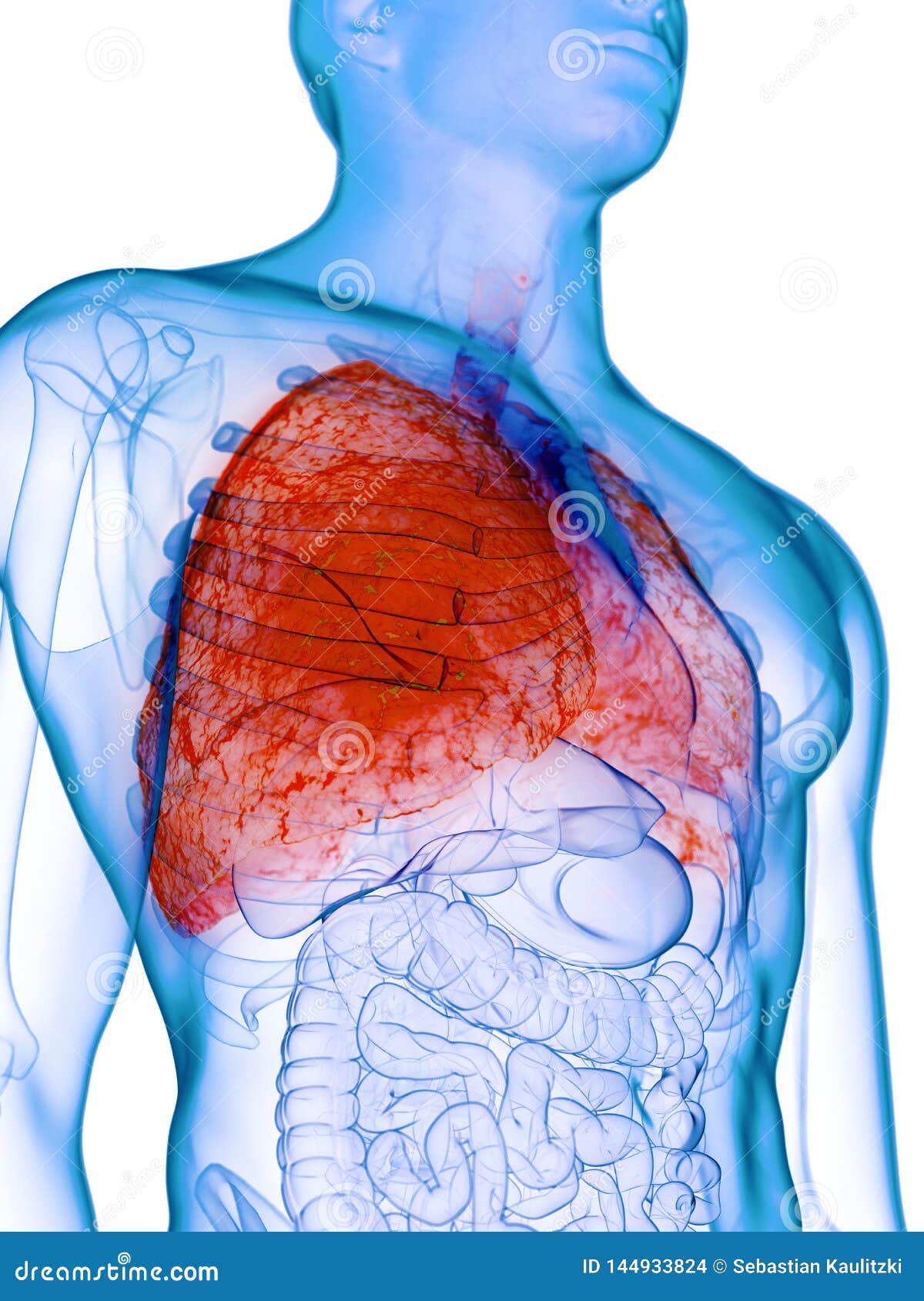Pneumoconiosis And Painful Human Condition, Pictured As A Wooden Human ...