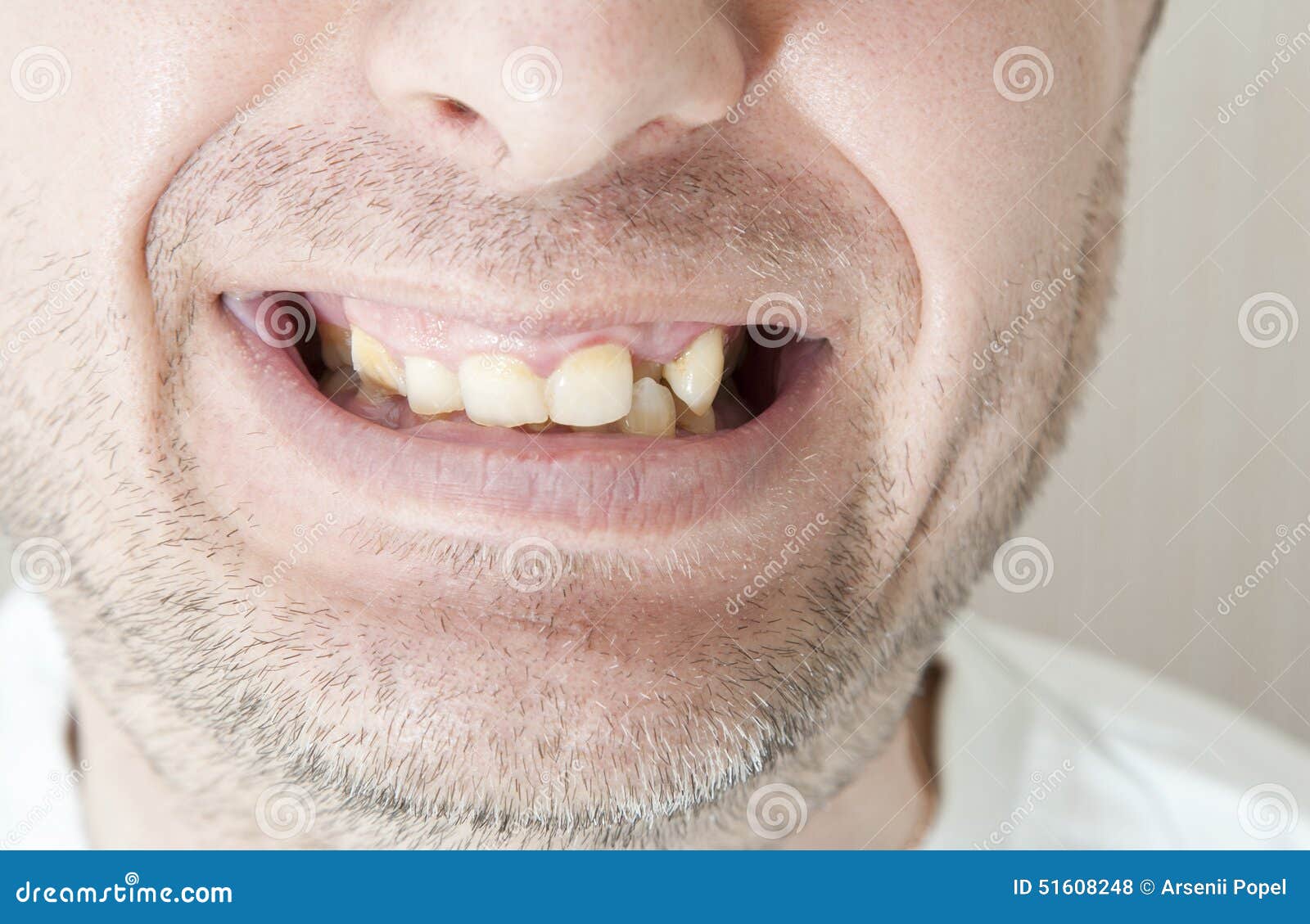 Diseased Teeth of the Patient Stock Photo - Image of decay ...