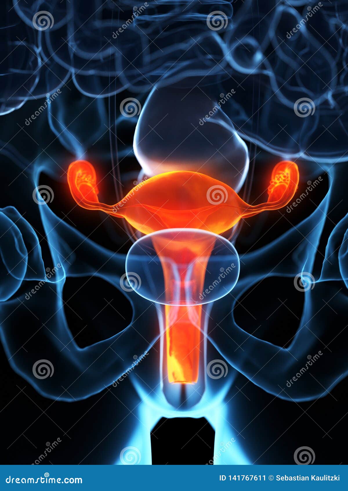 A diseased uterus stock illustration. Illustration of inflamed - 141767611