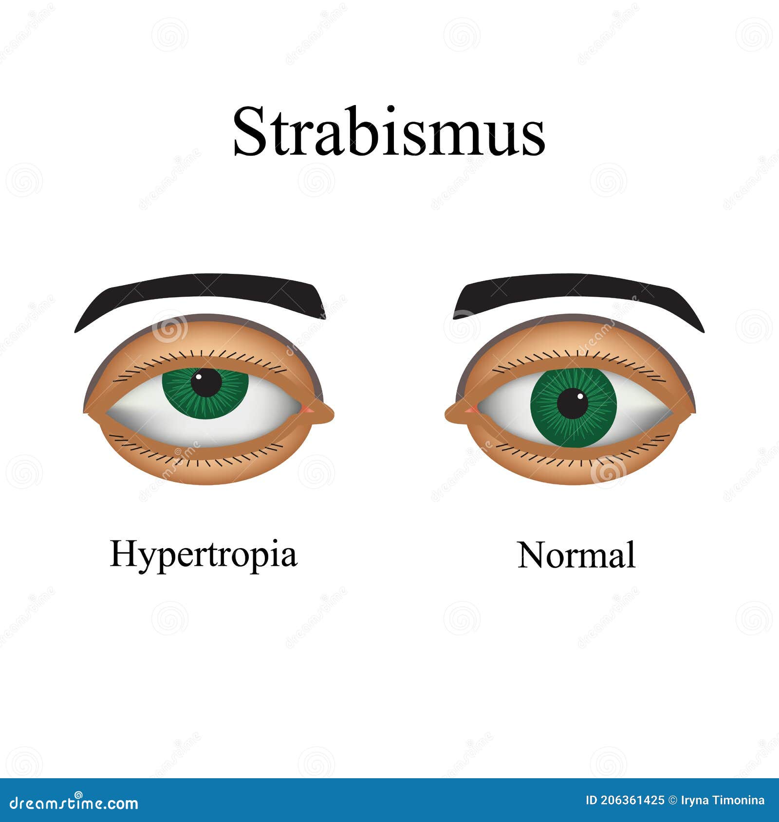 Hypertropia Cartoons, Illustrations & Vector Stock Images - 89 Pictures ...