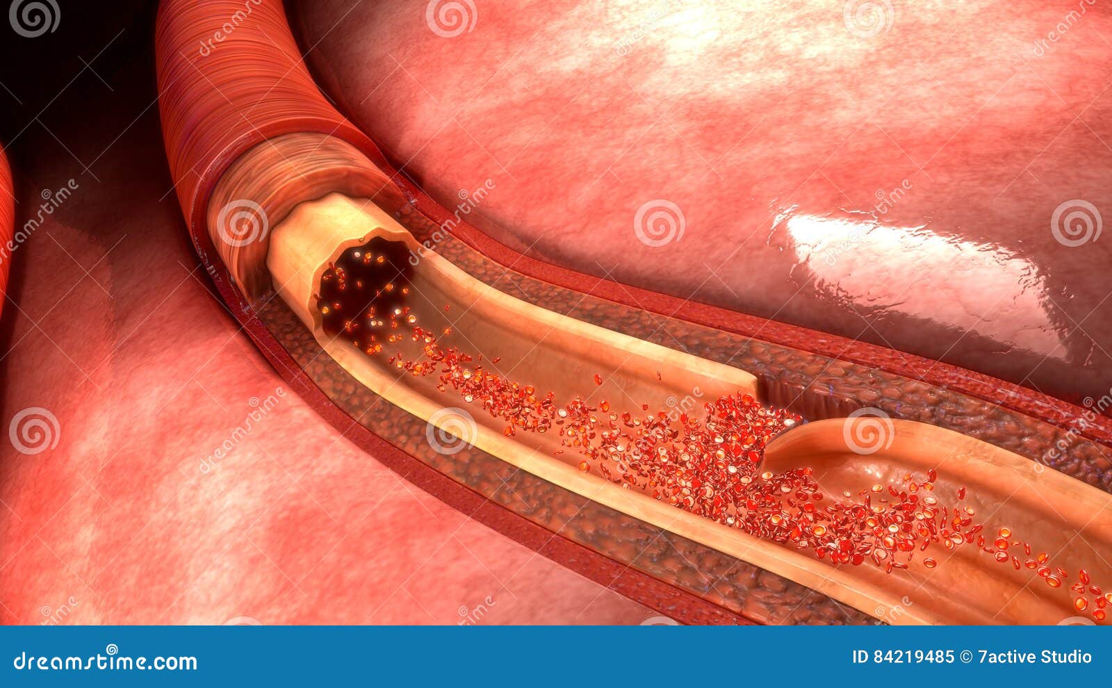 Disección de la arteria imagen de archivo. Imagen de aorta - 84219485