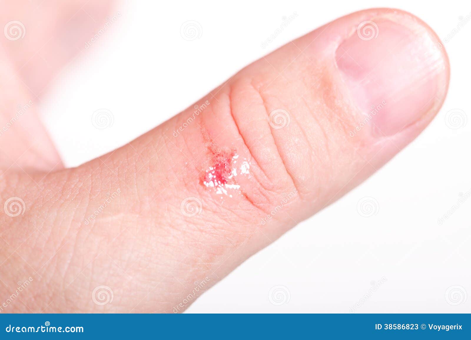 Disinfect the Scratch Alcohol Cuts Hand Health Stock Image - Image of ...