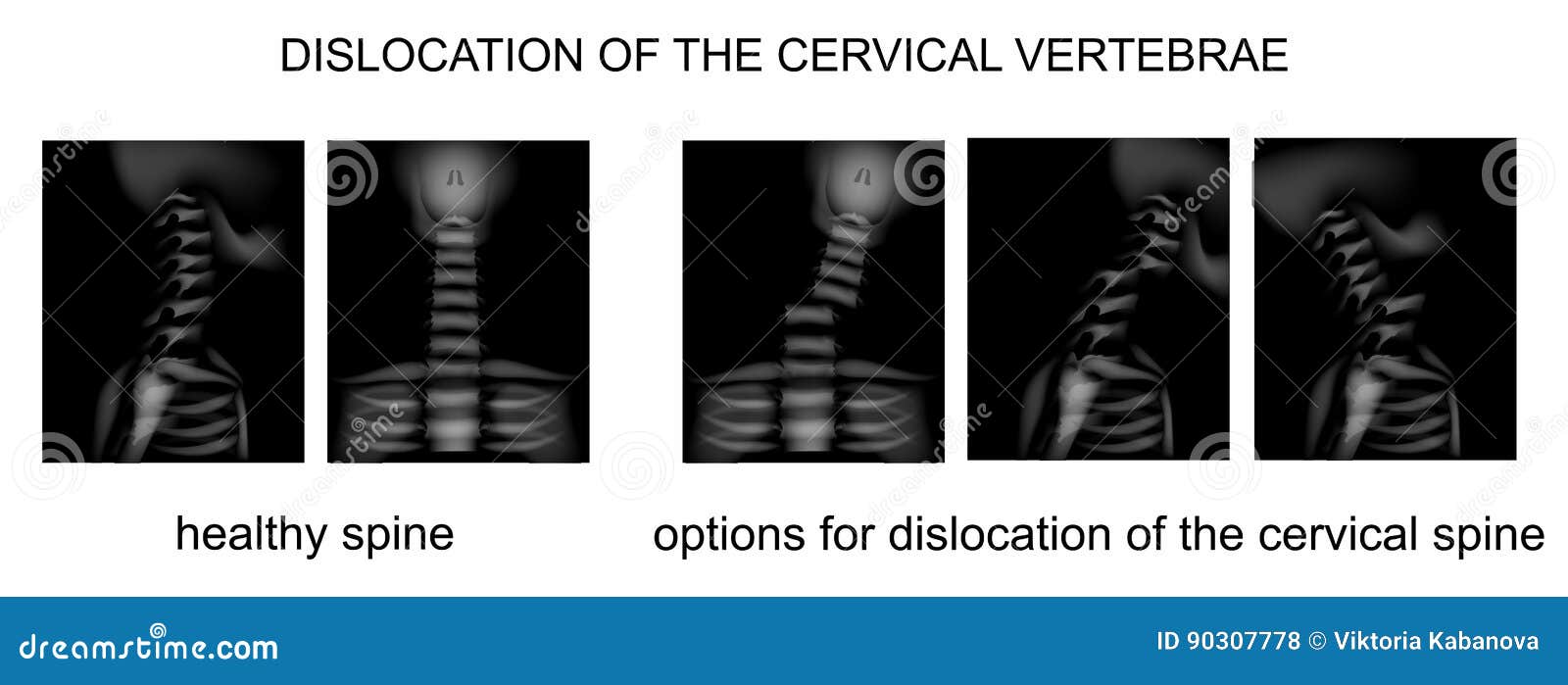 Dislocación De La Espina Dorsal Ilustración del Vector - Ilustración de ...