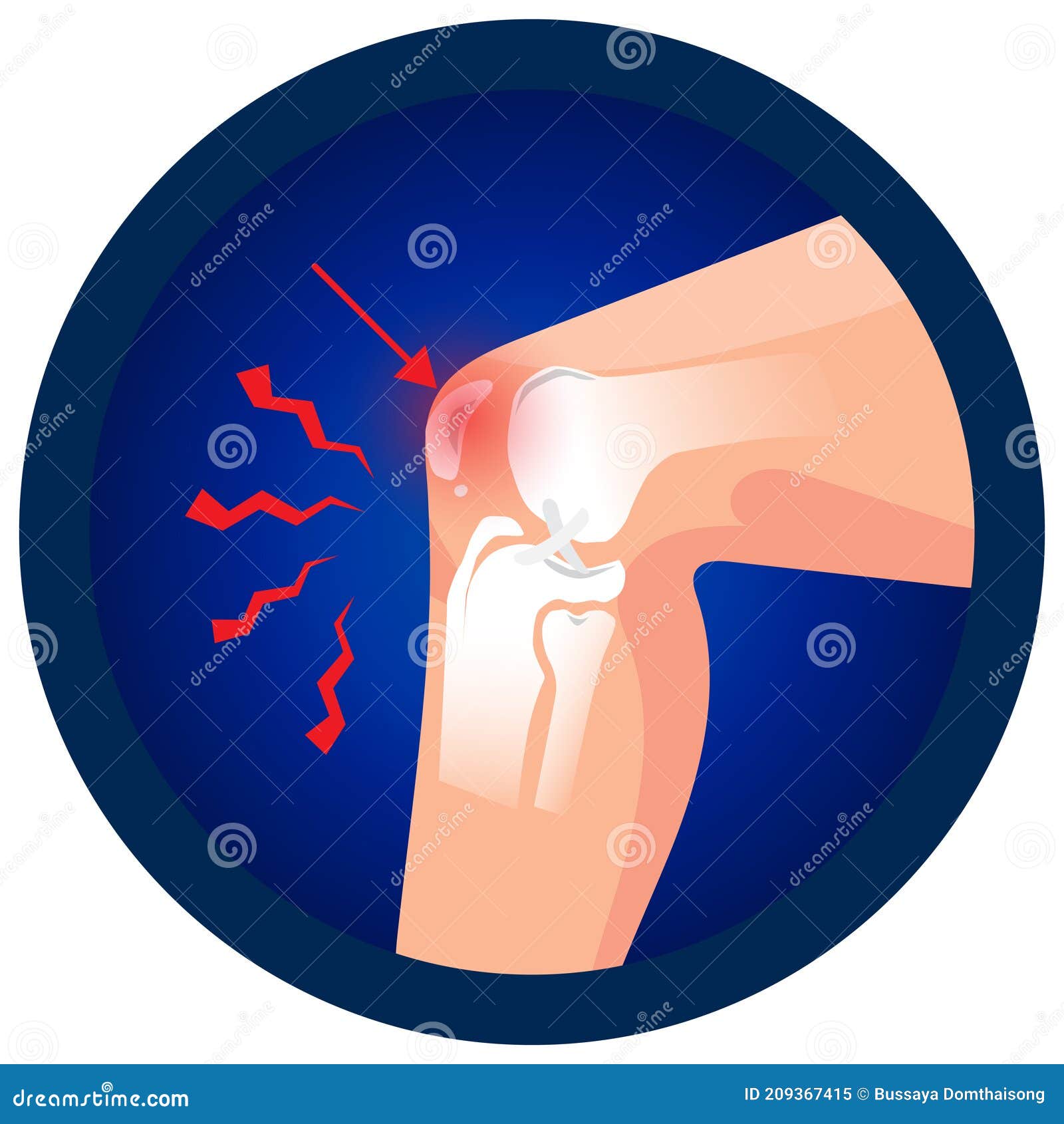 Meniscus Injury of Knee Icon. Vector Flat Design for Radiology ...