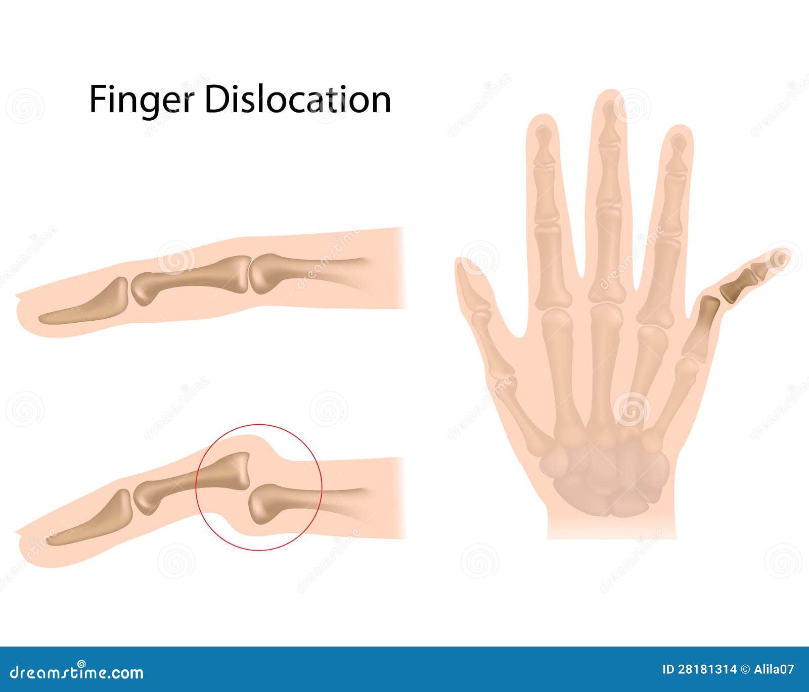 Dislocation de doigt illustration de vecteur. Illustration of phalanges ...