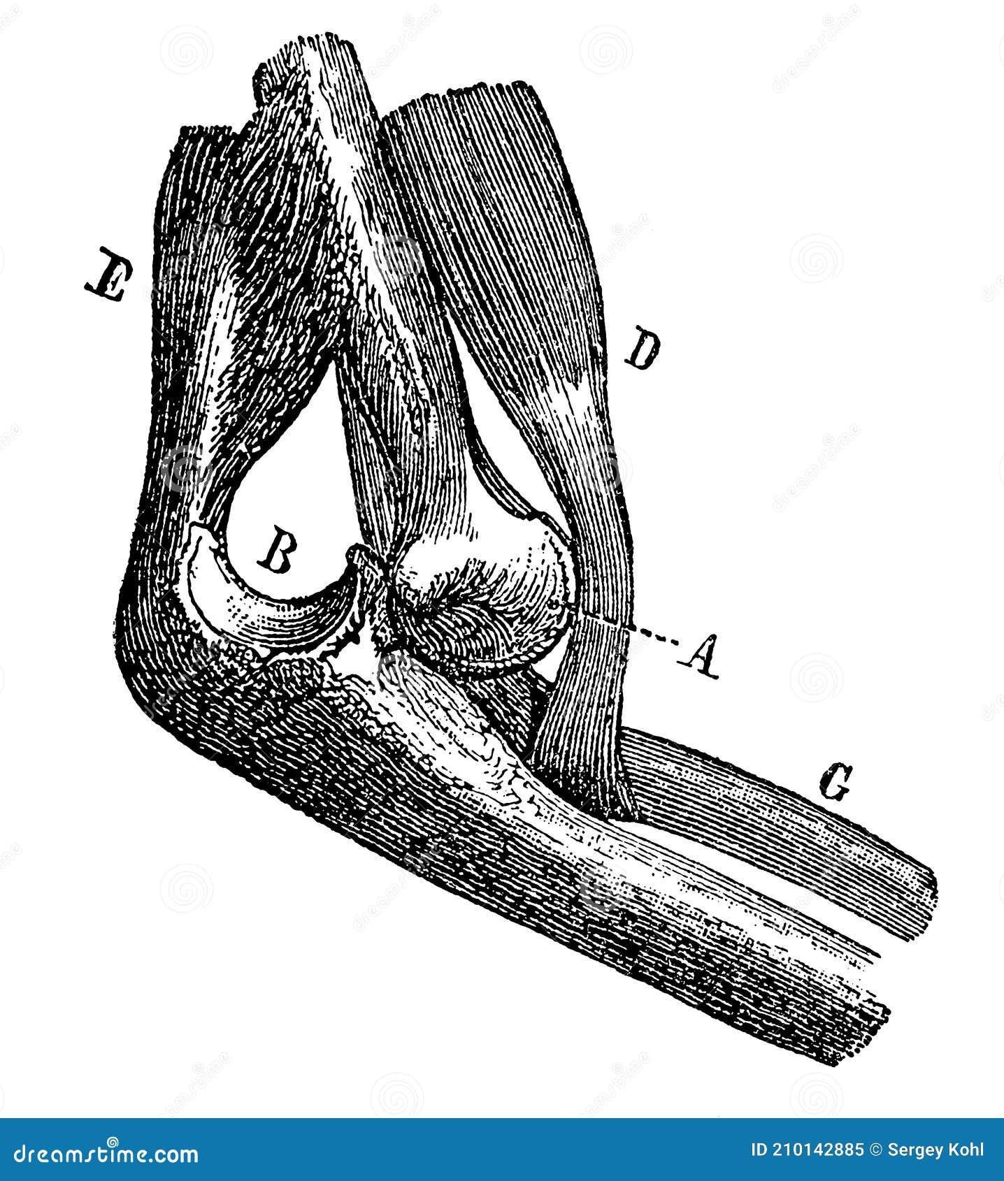Dislocation Of The Elbow Joint. Stock Image | CartoonDealer.com #210142885
