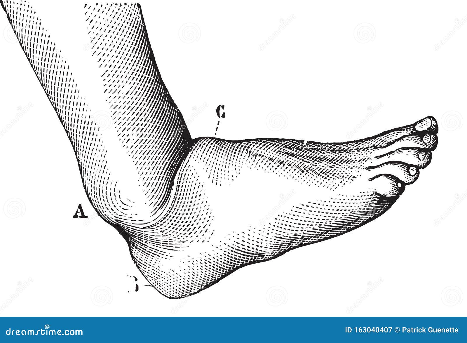 Dislocation Of The Foot Forward, Vintage Engraving Cartoon Vector ...