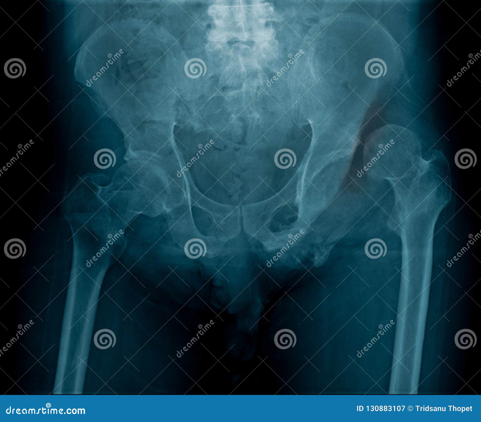 Dislocation of Left Hip Joint Stock Image - Image of patient, anatomy ...