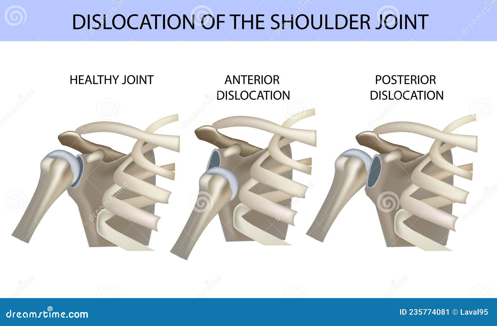 Dislocation of the Shoulder Joint, Medical Vector Illustration Stock ...