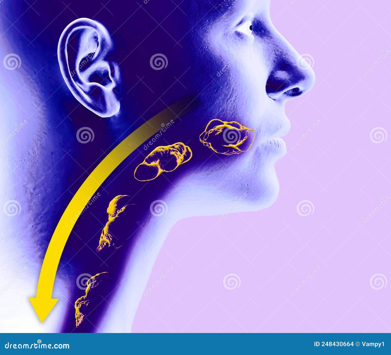 Dysphagia Cartoons Illustrations Vector Stock Images - vrogue.co Dysphagia Cartoons Illustrations Vector Stock Images - vrogue.co