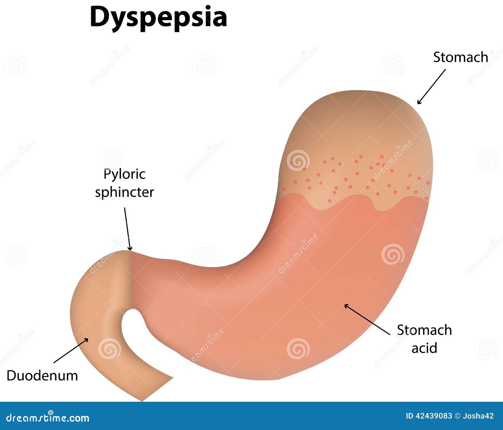 Dispepsia illustrazione vettoriale. Illustrazione di dispepsia - 42439083