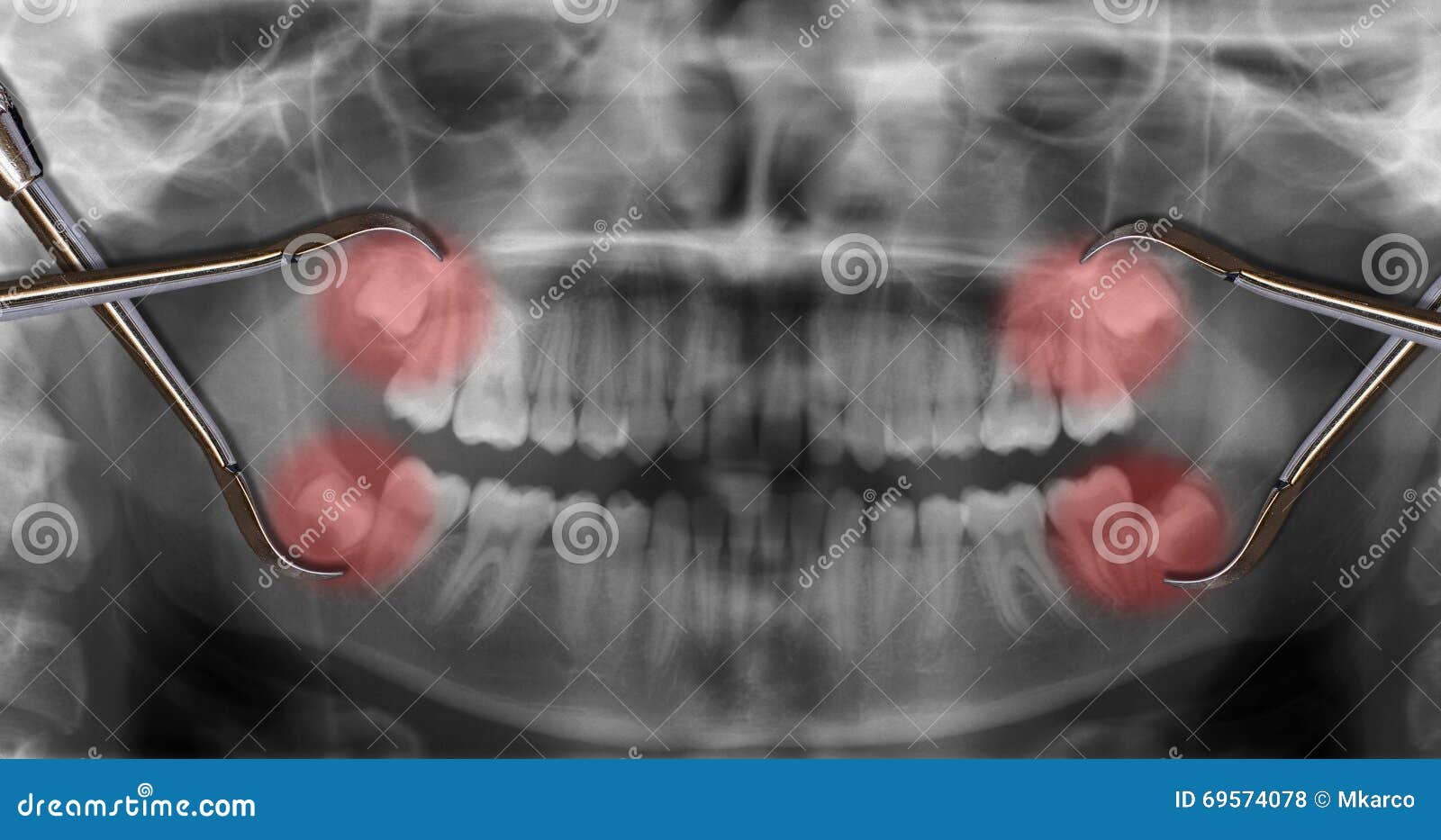 Display Four Wisdom Teeth Over X-ray Stock Photo - Image of scanner ...
