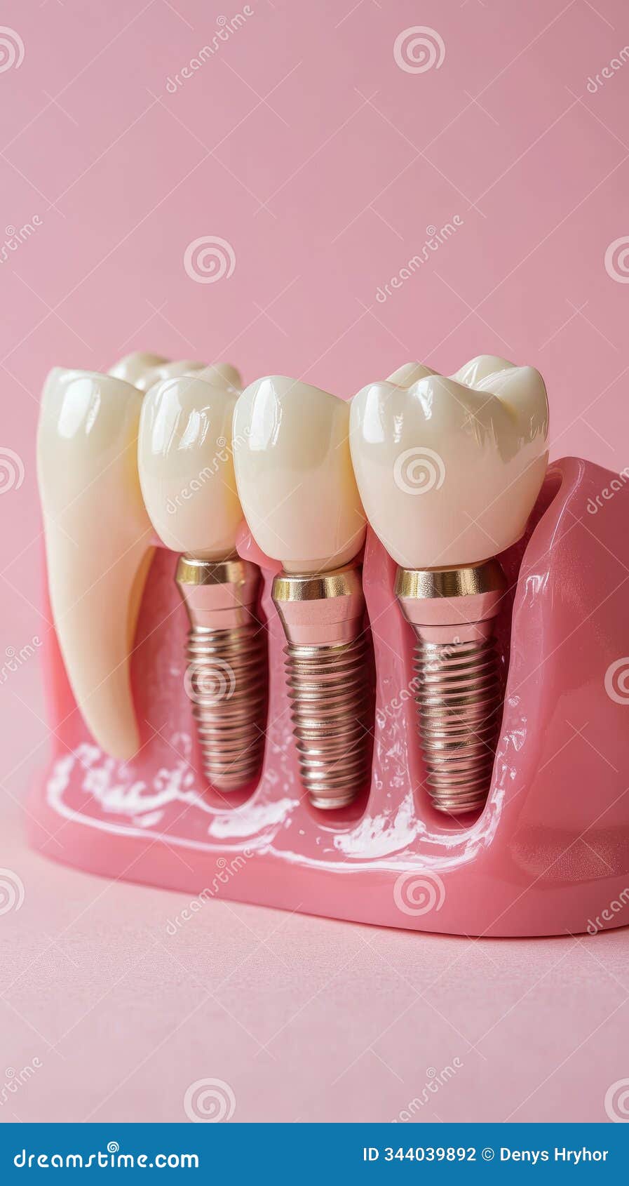 This Display Highlights Dental Implants, Demonstrating Their Design and ... This Display Highlights Dental Implants, Demonstrating Their Design and ...