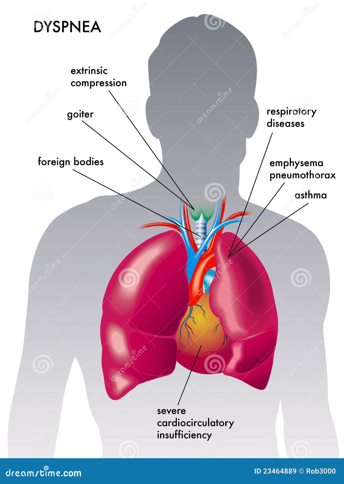Dispnea illustrazione vettoriale. Illustrazione di gozzo - 23464889
