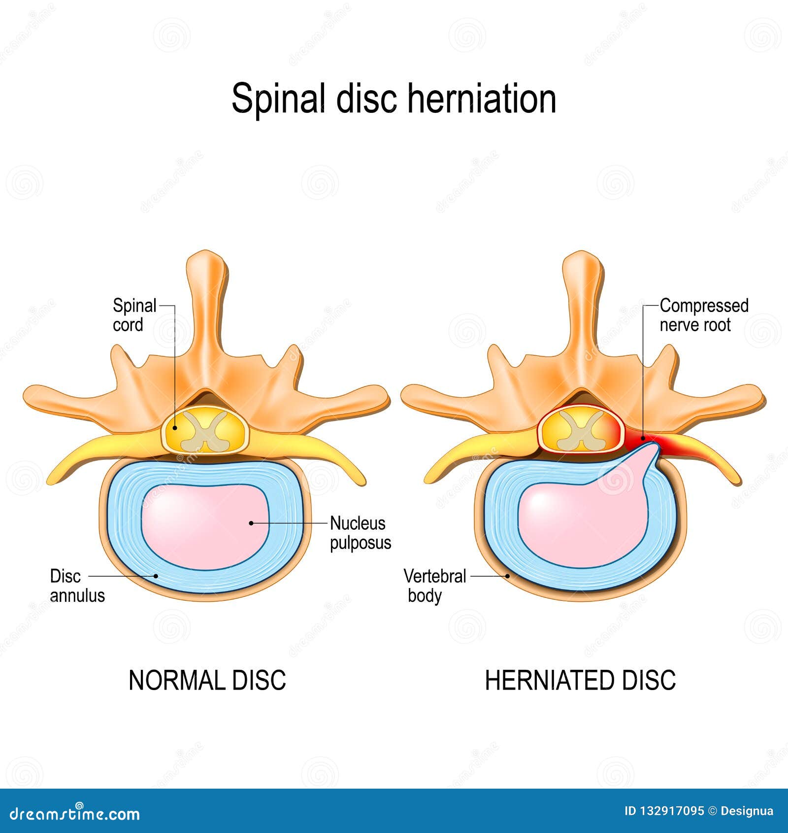 Disque Normal Et Herniation Spinal De Disque Dans Des Vertèbres ...