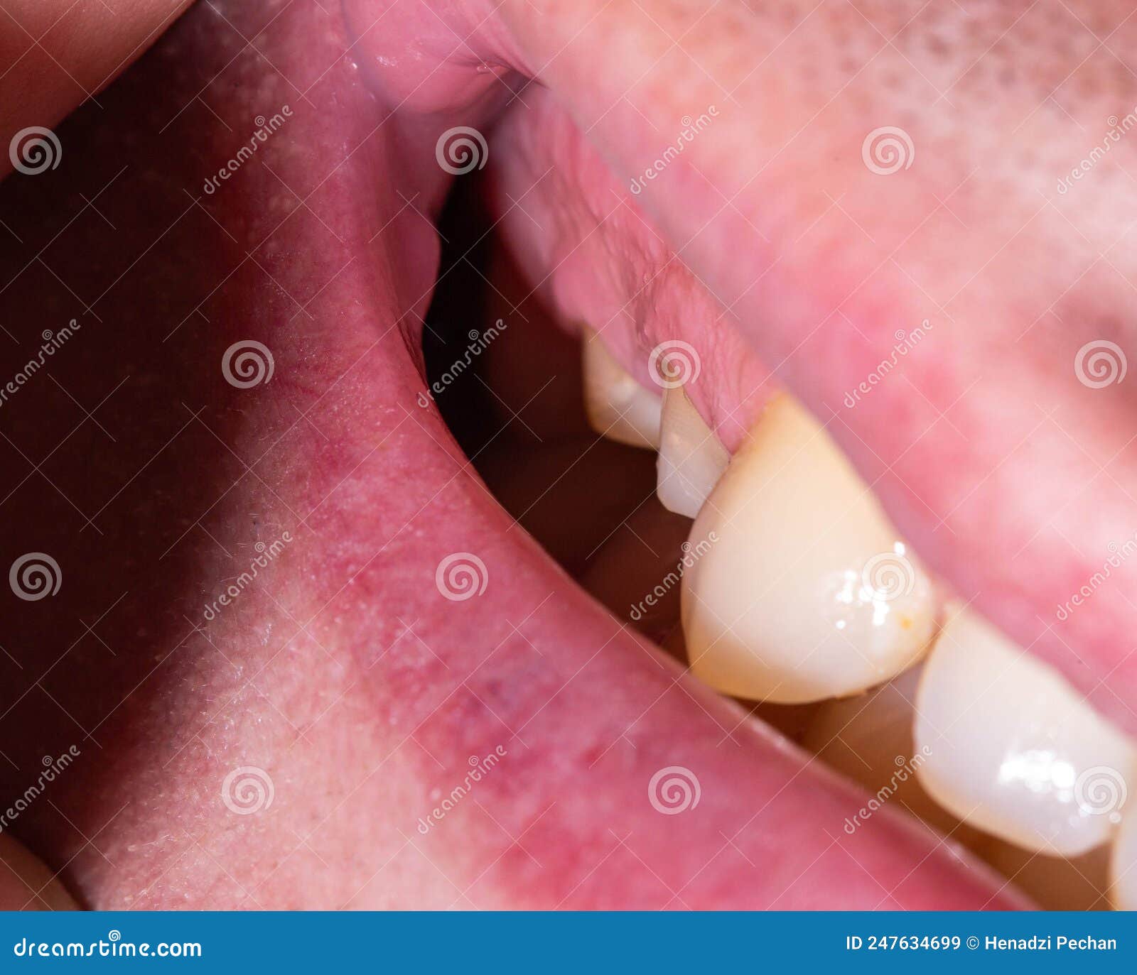 Installation Of Crown Moldings Trim On The Ceiling Stock Image ...