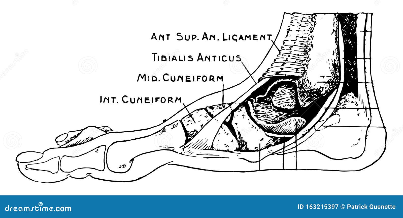 Flat Foot Pathology With Fallen And Normal Arch Comparison Outline ...